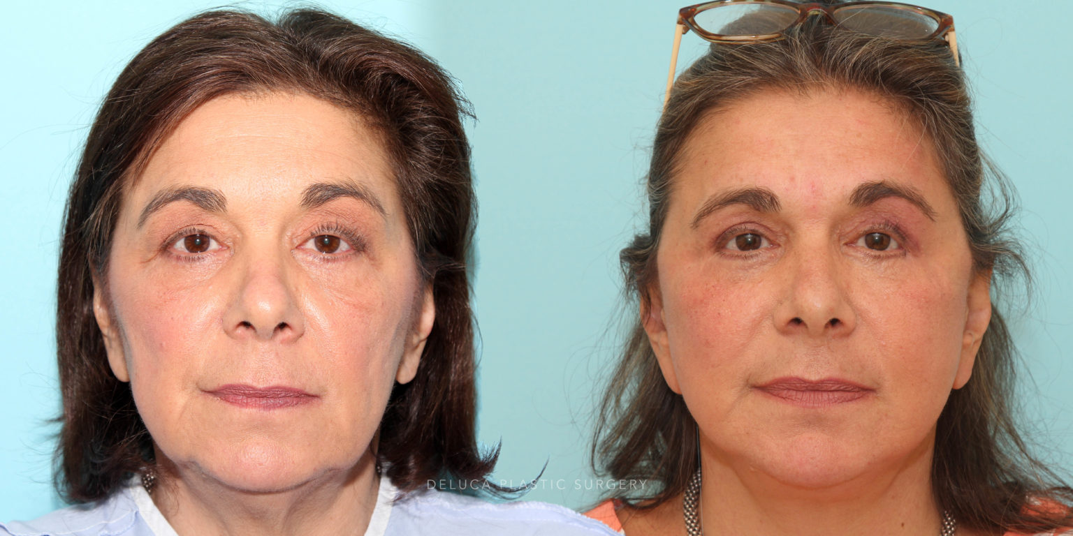 60 y/o Modified Face and Neck Lift Neck Liposuction Blepharoplasty ...