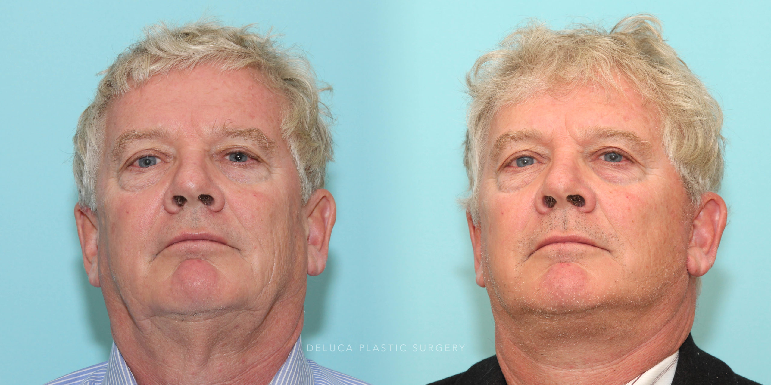 Facelift Surgery - DeLuca Plastic Surgery - Albany NY