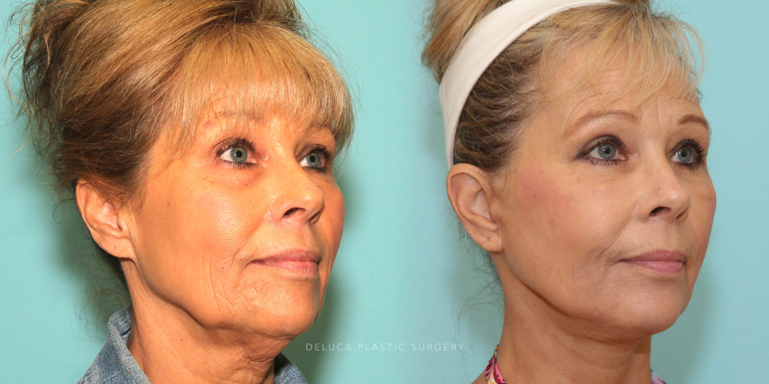 60 y/o Modified Face and Neck Lift Liposuction Neck and Blepharoplasty ...