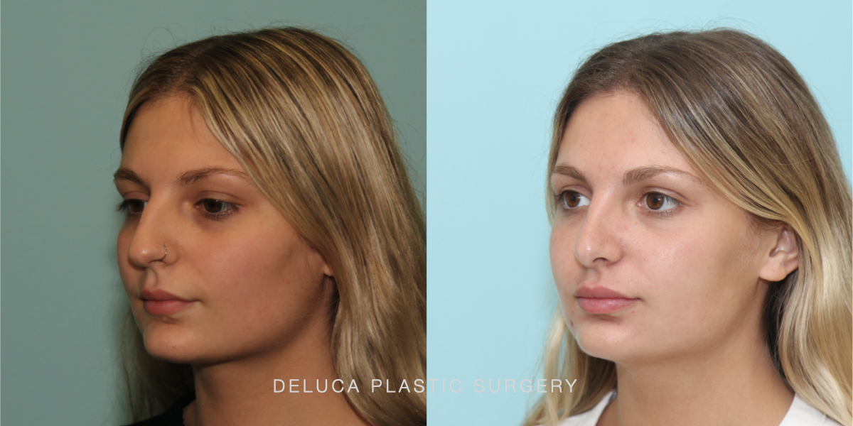 23 y/o Rhinoplasty - DeLuca Plastic Surgery - Albany NY