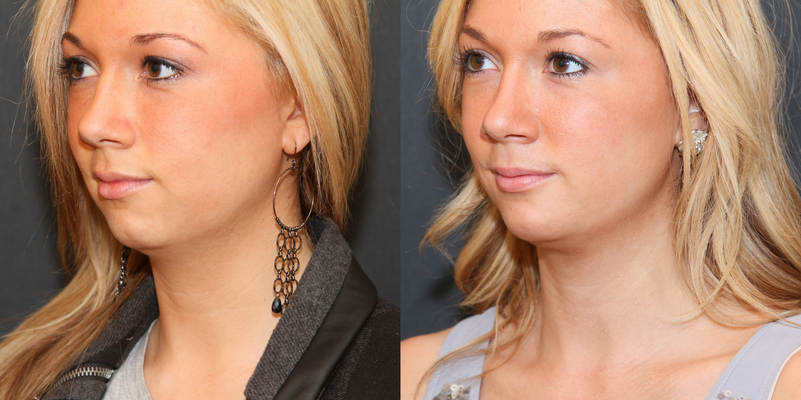 Chin Augmentation - DeLuca Plastic Surgery - Albany NY