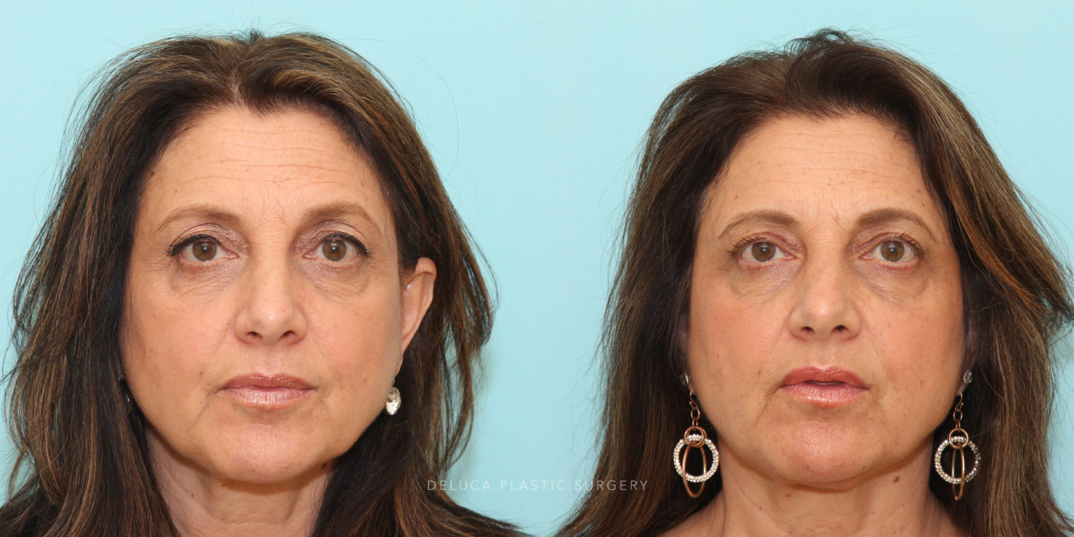 Upper Lid Pinch Blepharoplasty - DeLuca Plastic Surgery - Albany NY