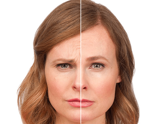 Botox Basics - DeLuca Plastic Surgery - Albany NY