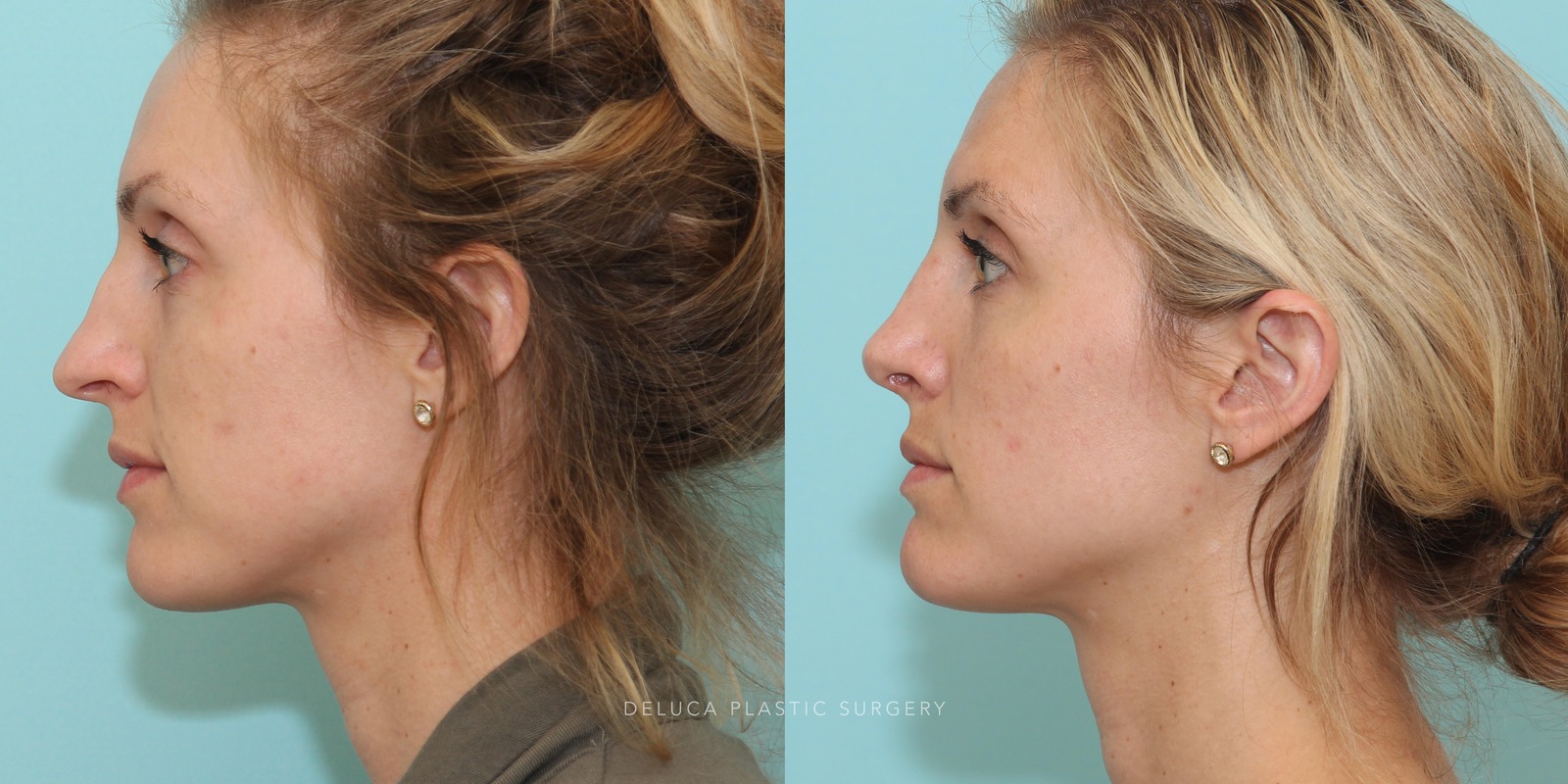 Open Septorhinoplasty For Deviated Nose With Difficulty Breathing